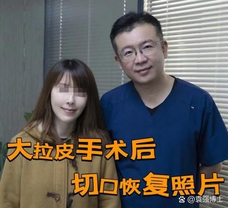 大拉皮手术15天照片_恢复期多久-第2张图片-山城妙识 大拉皮手术15天照片_恢复期多久-第2张图片-山城妙识