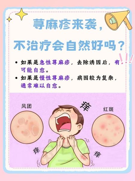 荨麻疹怎么快速自愈_荨麻疹自愈方法有哪些-第3张图片-山城妙识 荨麻疹怎么快速自愈_荨麻疹自愈方法有哪些-第3张图片-山城妙识