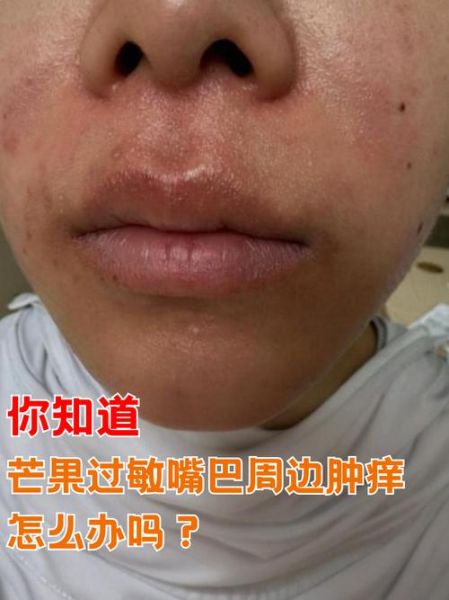 小孩吃芒果过敏症状_芒果过敏怎么办-第1张图片-山城妙识 小孩吃芒果过敏症状_芒果过敏怎么办-第1张图片-山城妙识