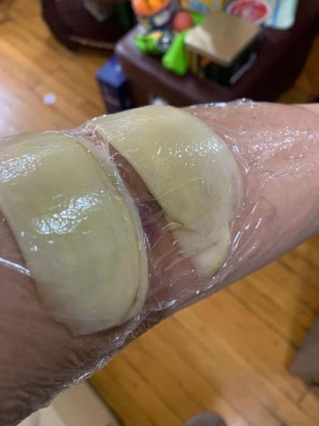 土豆片消肿的正确方法_土豆片敷多久能消肿-第1张图片-山城妙识 土豆片消肿的正确方法_土豆片敷多久能消肿-第1张图片-山城妙识