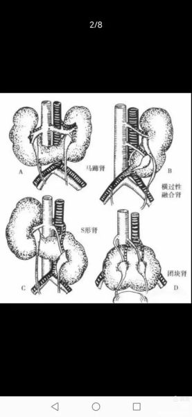 马蹄肾是什么_马蹄肾有什么症状-第1张图片-山城妙识 马蹄肾是什么_马蹄肾有什么症状-第1张图片-山城妙识