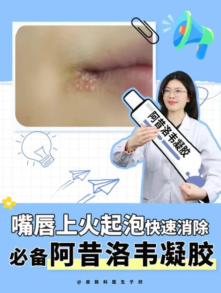 嘴皮起泡上火怎么快速消除_嘴角起泡吃什么药好得快-第1张图片-山城妙识