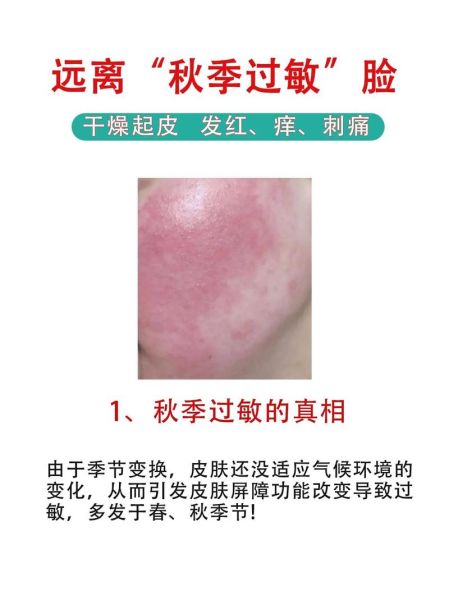 过敏症状有哪些表现_过敏症状怎么快速缓解-第2张图片-山城妙识