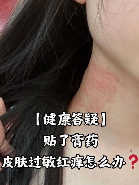 过敏症状有哪些表现_过敏症状怎么快速缓解-第3张图片-山城妙识