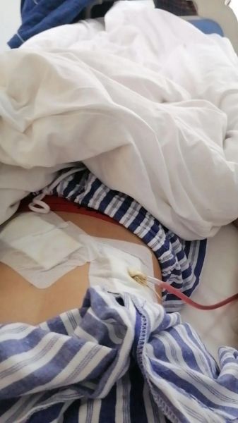 阑尾炎手术后几天出院_术后多久能回家-第1张图片-山城妙识