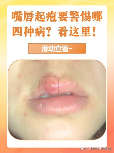 嘴唇起泡是什么原因_嘴唇起泡是上火吗-第1张图片-山城妙识 嘴唇起泡是什么原因_嘴唇起泡是上火吗-第1张图片-山城妙识