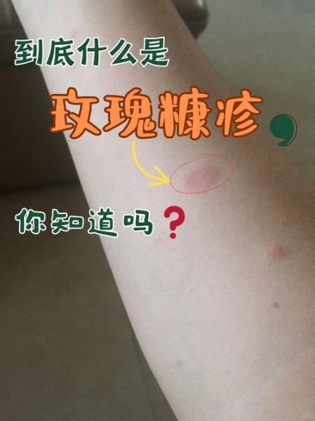 玫瑰糠疹是怎么引起的_玫瑰糠疹传染吗-第1张图片-山城妙识