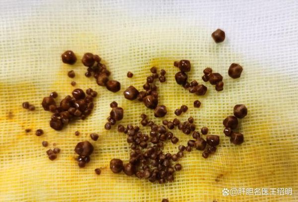 2厘米胆结石自己消失了_胆结石能自愈吗-第2张图片-山城妙识 2厘米胆结石自己消失了_胆结石能自愈吗-第2张图片-山城妙识