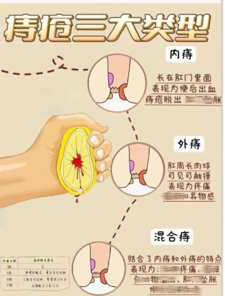 痔疮能自愈吗_痔疮自愈的锻炼方法-第3张图片-山城妙识