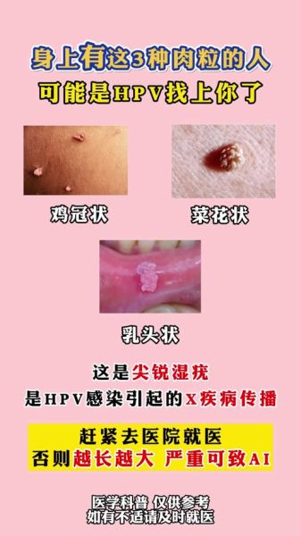 菜花病女性一般长在哪_初期症状有哪些-第2张图片-山城妙识 菜花病女性一般长在哪_初期症状有哪些-第2张图片-山城妙识