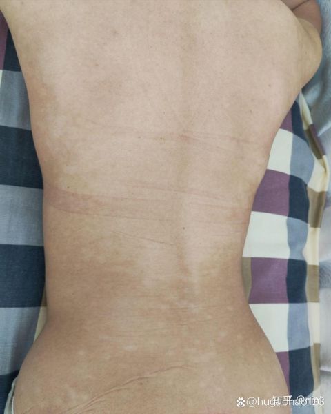 色素减退斑是怎么引起的_能自愈吗-第2张图片-山城妙识