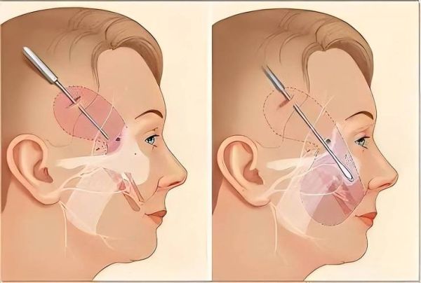 拉皮是怎么做出来的_拉皮手术全过程揭秘-第1张图片-山城妙识 拉皮是怎么做出来的_拉皮手术全过程揭秘-第1张图片-山城妙识