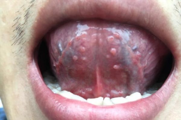 男性菜花状疣高清图片_早期症状有哪些-第2张图片-山城妙识 男性菜花状疣高清图片_早期症状有哪些-第2张图片-山城妙识