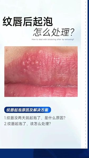嘴唇起泡是癌的预兆_嘴唇起泡多久不愈合要警惕-第1张图片-山城妙识