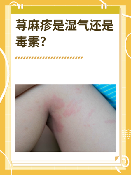 荨麻疹是毒素还是湿气_中医西医怎么看-第2张图片-山城妙识 荨麻疹是毒素还是湿气_中医西医怎么看-第2张图片-山城妙识