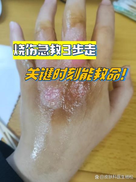 辣椒素严重渗透到皮肤里怎么办_辣椒素灼伤皮肤急救-第3张图片-山城妙识 辣椒素严重渗透到皮肤里怎么办_辣椒素灼伤皮肤急救-第3张图片-山城妙识