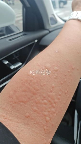 吃虾的禁忌人群有哪些_虾过敏能吃吗-第3张图片-山城妙识 吃虾的禁忌人群有哪些_虾过敏能吃吗-第3张图片-山城妙识