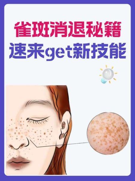 雀斑怎么去除_雀斑去除最有效的方法-第2张图片-山城妙识 雀斑怎么去除_雀斑去除最有效的方法-第2张图片-山城妙识