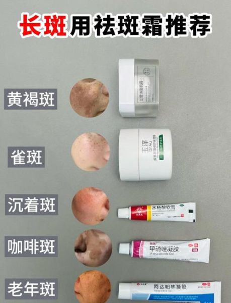 雀斑怎么去除_雀斑去除最有效的方法-第3张图片-山城妙识 雀斑怎么去除_雀斑去除最有效的方法-第3张图片-山城妙识