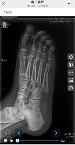 脆骨病多大就不骨折了_成年后还会骨折吗-第1张图片-山城妙识