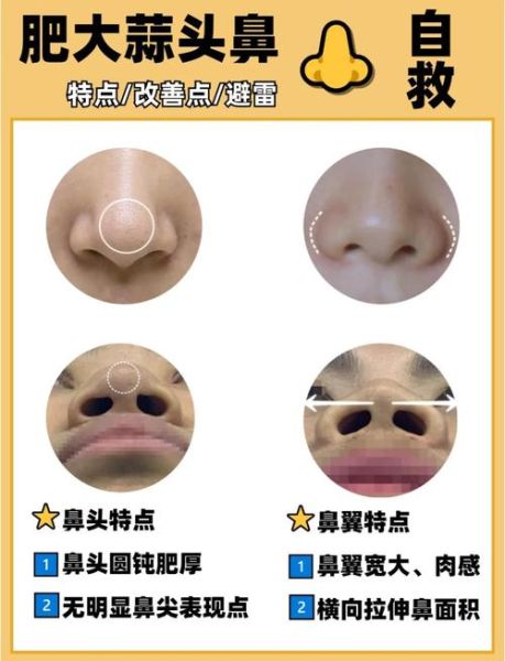 大蒜鼻怎么办_大蒜鼻怎么改善-第2张图片-山城妙识 大蒜鼻怎么办_大蒜鼻怎么改善-第2张图片-山城妙识