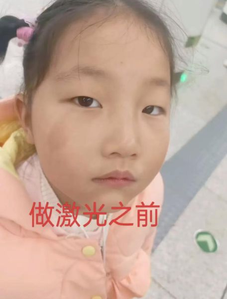 牛奶咖啡斑是什么_牛奶咖啡斑会遗传吗-第2张图片-山城妙识 牛奶咖啡斑是什么_牛奶咖啡斑会遗传吗-第2张图片-山城妙识