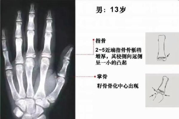 男孩停止长高的征兆_如何判断骨骼线闭合-第3张图片-山城妙识