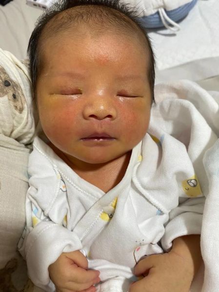 蚕豆病过敏症状图片_如何识别蚕豆病急性发作-第2张图片-山城妙识