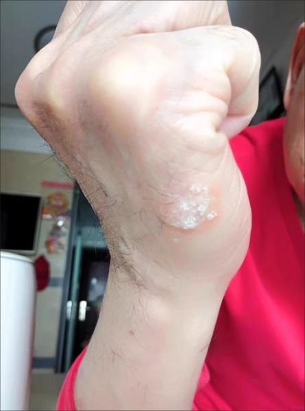 鹅掌风会传染吗_鹅掌风用什么药膏好-第2张图片-山城妙识 鹅掌风会传染吗_鹅掌风用什么药膏好-第2张图片-山城妙识