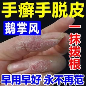 鹅掌风会传染吗_鹅掌风用什么药膏好-第3张图片-山城妙识 鹅掌风会传染吗_鹅掌风用什么药膏好-第3张图片-山城妙识