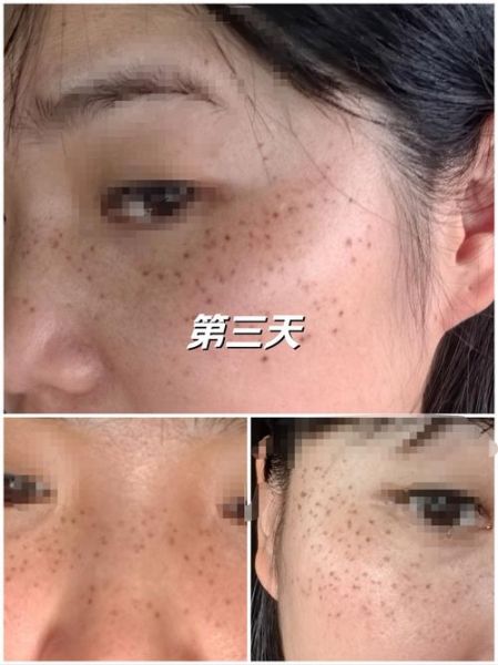 蜂巢皮秒祛斑效果怎么样_蜂巢皮秒恢复期多久-第2张图片-山城妙识