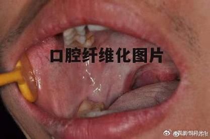 吃槟榔口腔癌图片真实_槟榔导致口腔癌早期症状有哪些-第3张图片-山城妙识