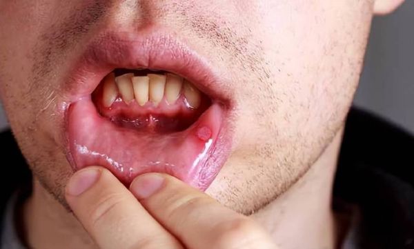 吃槟榔口腔癌图片真实_槟榔导致口腔癌早期症状有哪些-第1张图片-山城妙识