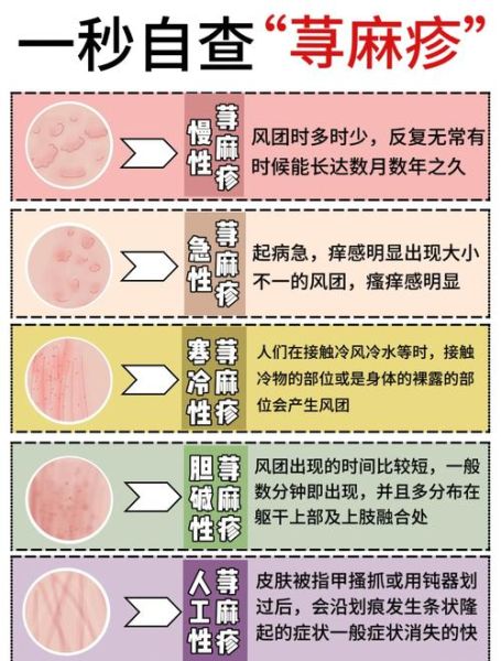 荨麻疹最怕三个土方法_真的有用吗-第1张图片-山城妙识