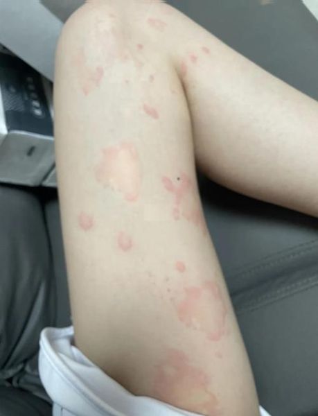 荨麻疹最怕三个土方法_真的有用吗-第3张图片-山城妙识