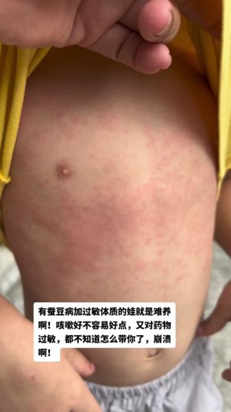 蚕豆病发作有哪些症状_蚕豆病急性溶血表现-第1张图片-山城妙识