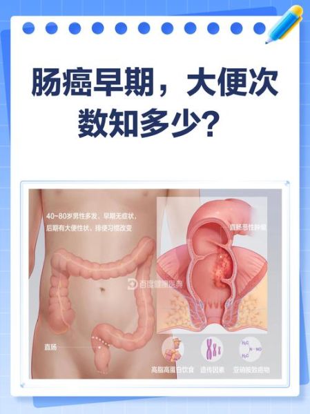 肠癌早期一天几次大便_肠癌早期排便次数变化-第1张图片-山城妙识