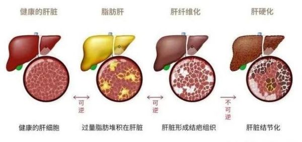 轻度脂肪肝严重吗_需要吃药吗-第1张图片-山城妙识 轻度脂肪肝严重吗_需要吃药吗-第1张图片-山城妙识