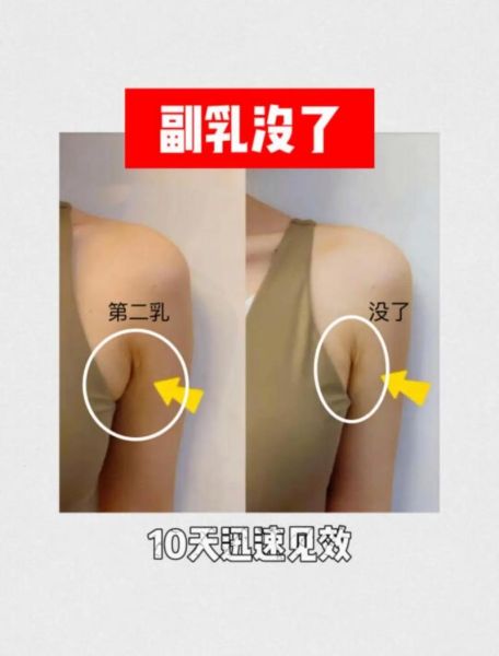 副乳怎么可以消除_副乳消除最有效的方法-第1张图片-山城妙识