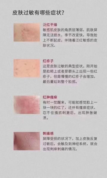 过敏怎么办_过敏症状怎么快速缓解-第2张图片-山城妙识