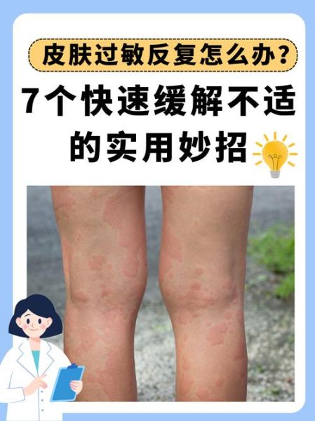 过敏怎么办_过敏症状怎么快速缓解-第3张图片-山城妙识