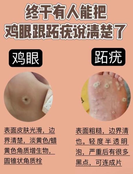 鸡眼图片长什么样_鸡眼和跖疣区别图解-第1张图片-山城妙识