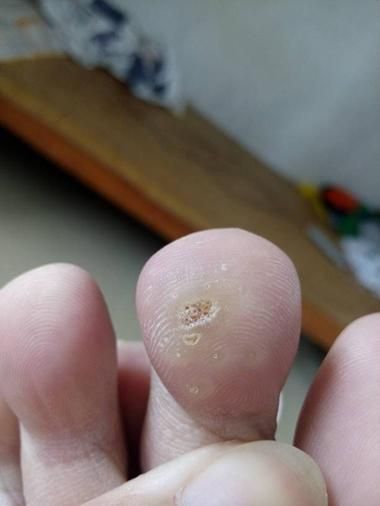 鸡眼图片初期_鸡眼初期症状图片-第2张图片-山城妙识