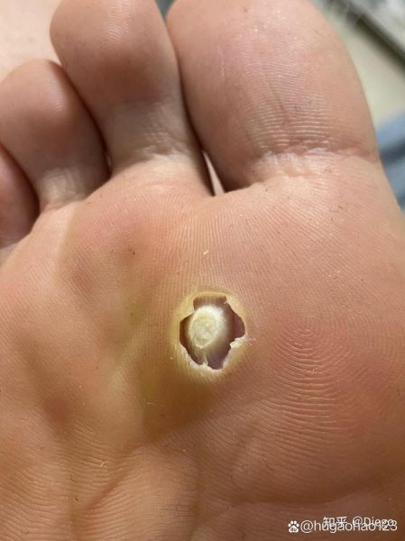 鸡眼图片初期_鸡眼初期症状图片-第1张图片-山城妙识