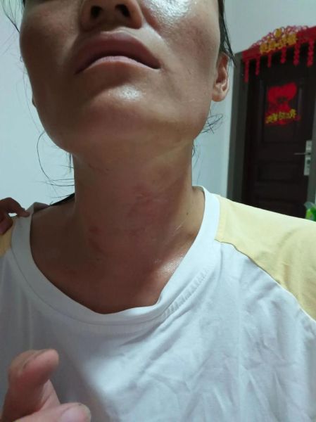 甲亢不到20天就好了_真的可能吗-第1张图片-山城妙识