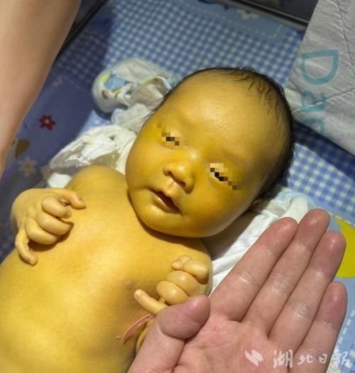 蚕豆病发作症状图片_蚕豆病图片怎么看-第2张图片-山城妙识