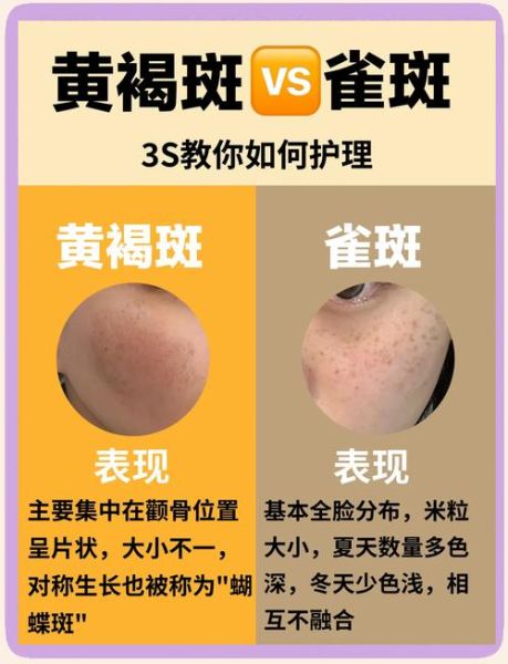 麻子和雀斑的区别_麻子雀斑怎么区分-第1张图片-山城妙识