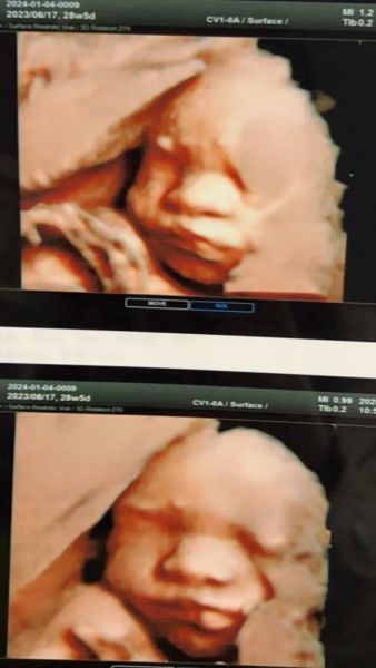 大排畸和四维的区别是什么_哪个更准确-第2张图片-山城妙识