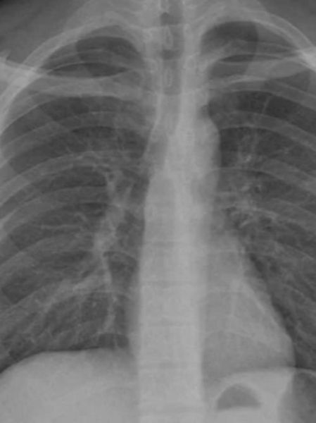 鳖甲煎丸为什么被停用_鳖甲煎丸停用原因-第3张图片-山城妙识