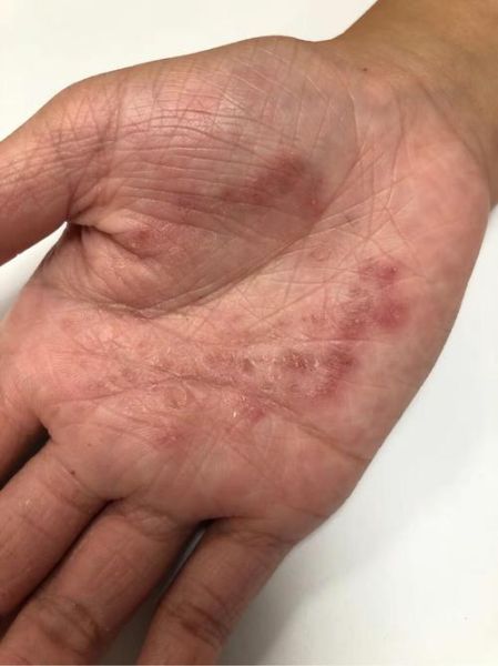 鹅掌风症状图片_鹅掌风初期长什么样-第1张图片-山城妙识